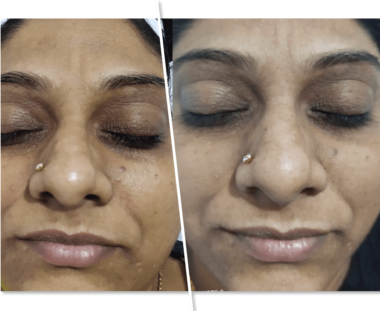 Skin Fairness & Whitening Treatment in Hyderabad, Bangalore, Chennai