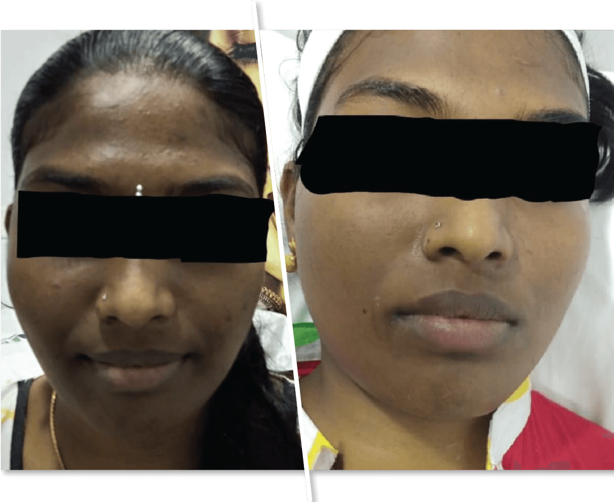 Skin Fairness & Whitening Treatment in Hyderabad, Bangalore, Chennai