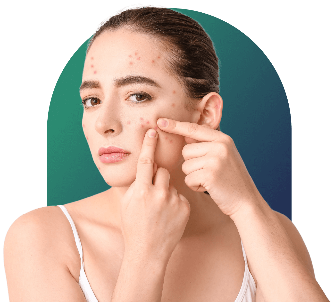 Natural Acne Treatment, Scar Removal in Bangalore, Hyderabad