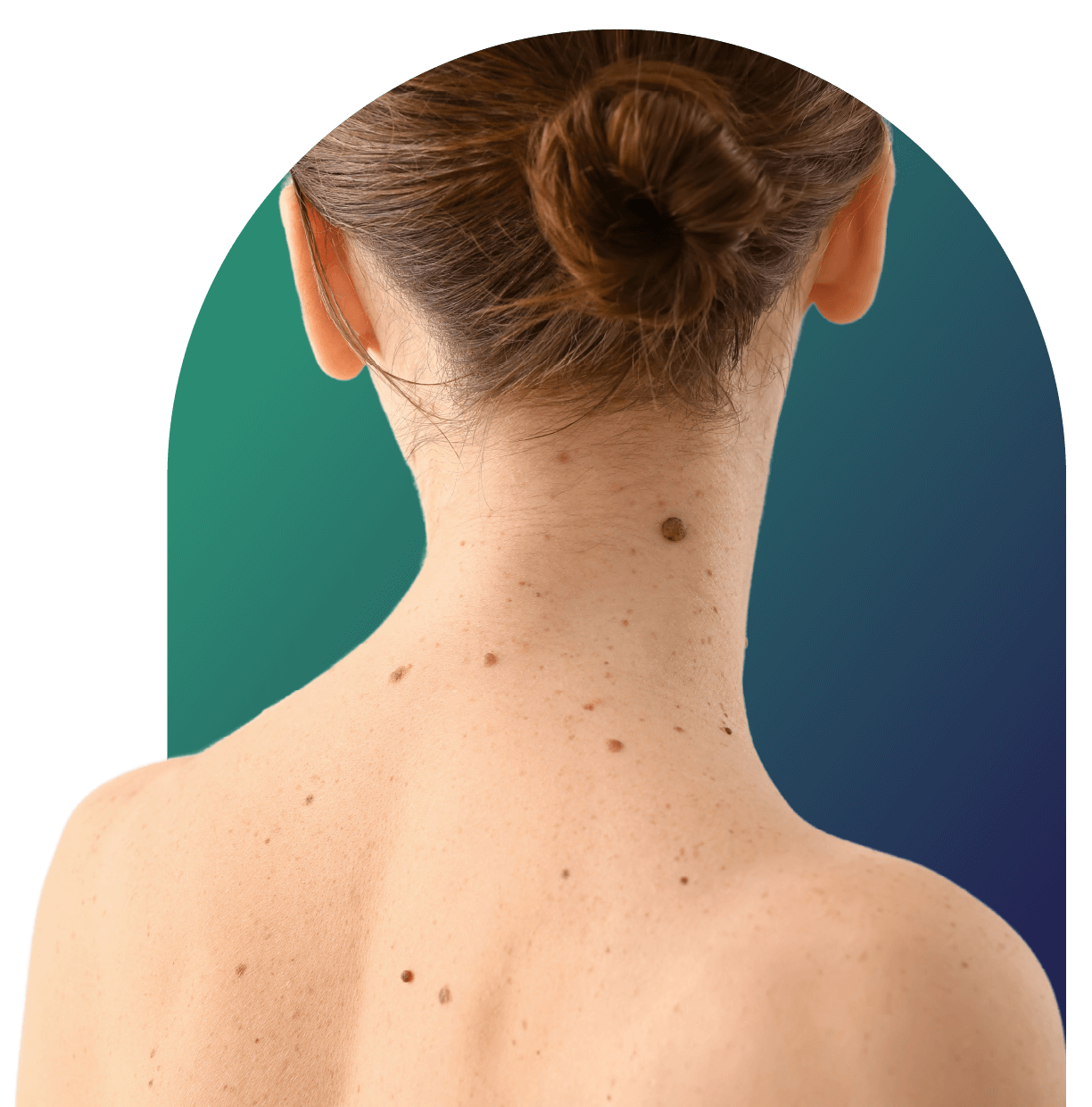 Laser Mole and Wart Removal Treatment in Hyderabad, Chennai