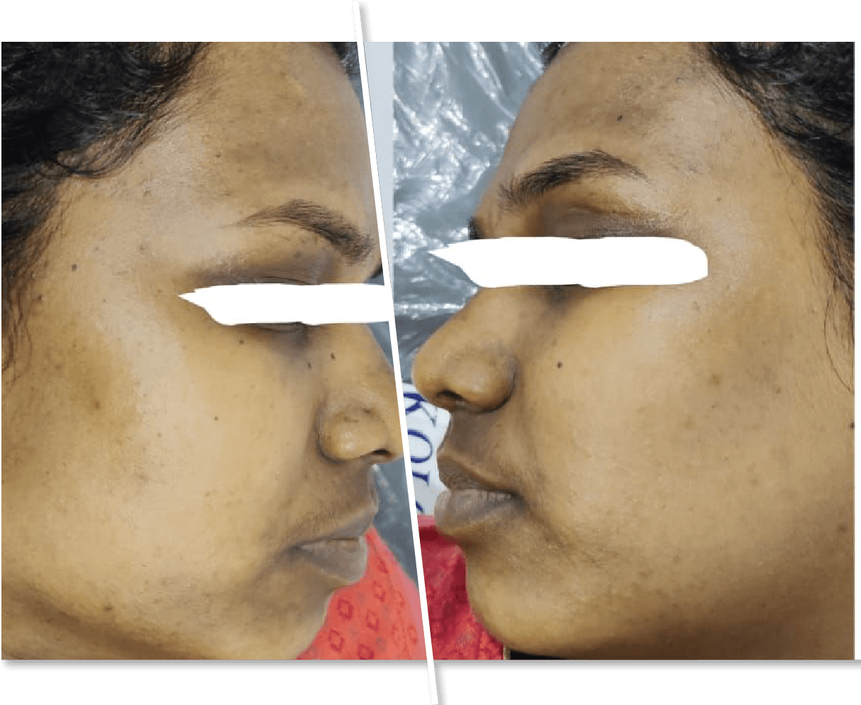 Deep Scar Removal Treatment in Hyderabad, Chennai, Bangalore
