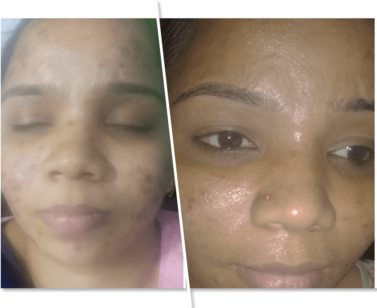 Deep Scar Removal Treatment in Hyderabad, Chennai, Bangalore