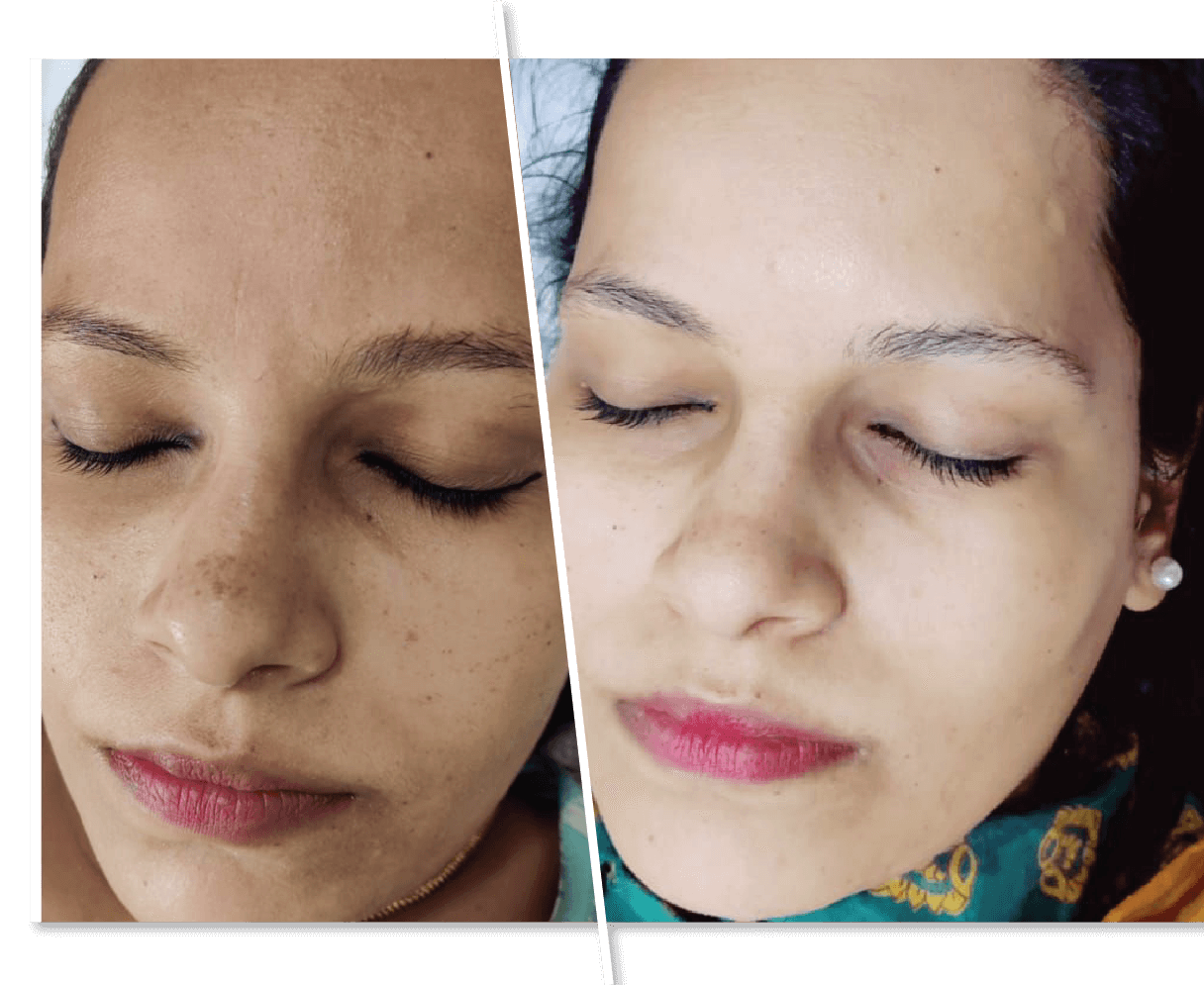 Skin Polishing & Brightening Treatment in Hyderabad, Chennai