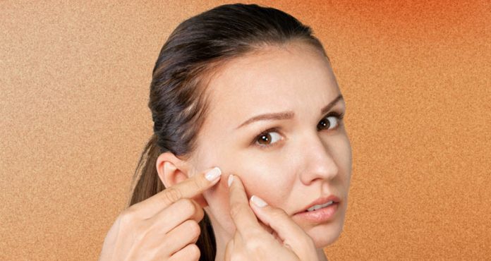 Acne Holes and Scarring on the Face: Types, Therapy, Cost