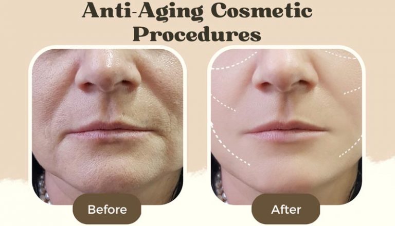 Top 4 Anti-Aging Cosmetic Procedures for Women over 50