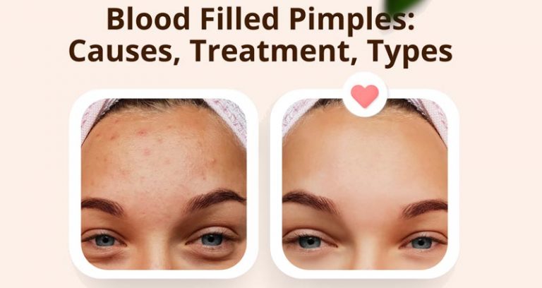 Blood Filled Pimples: Causes, Treatment, and Types