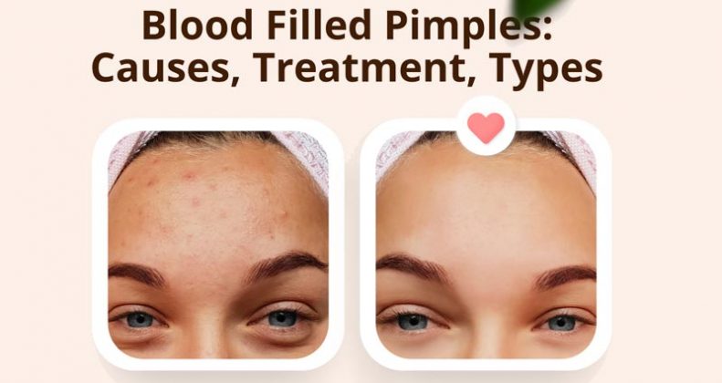 Blood Filled Pimples: Causes, Treatment, and Types