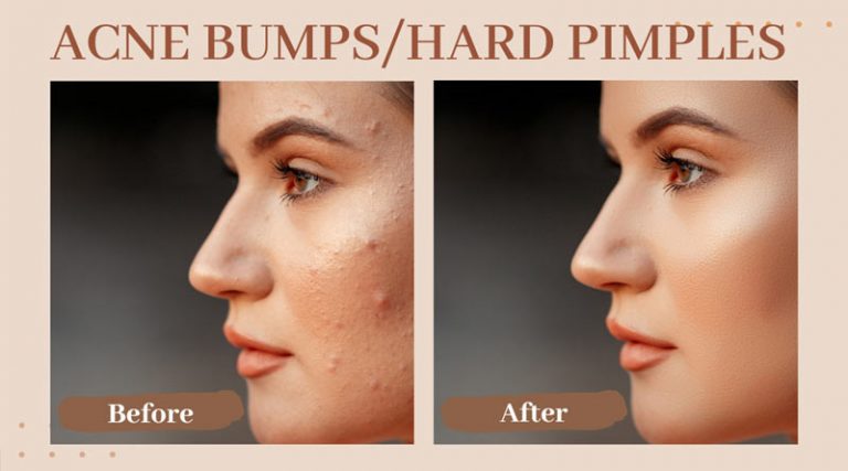 How to Get Rid of Acne Bumps or Hard Pimples?