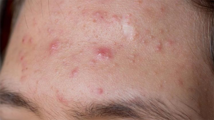 How To Get Rid Of Forehead Pimples - Types, Treatment