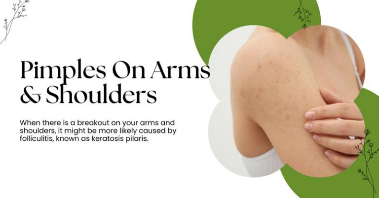 How to Remove Pimples on Arms and Shoulders - Body Acne
