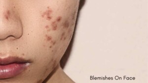 Blemishes On Face: Causes, Types, And Treatments - Kolors Healthcare India